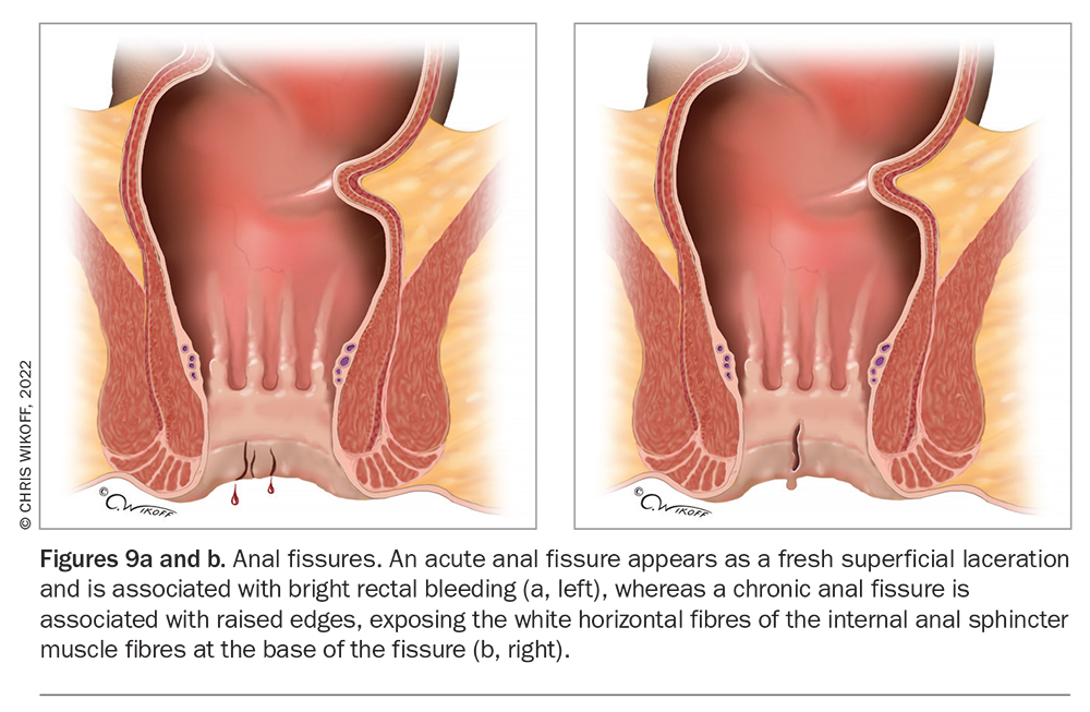 Chronic Fissure In Ano